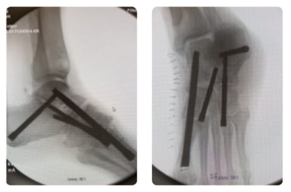 Charcot Foot Reconstruction Using Internal Fixation - Orthofix