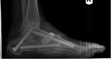 Charcot Surgical Reconstruction - Orthofix