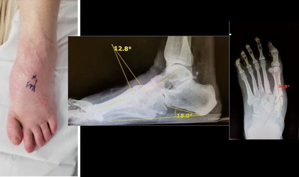 Charcot Surgical Reconstruction - Orthofix