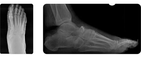 The Experts’ Definition of Diabetic Charcot Foot - Orthofix