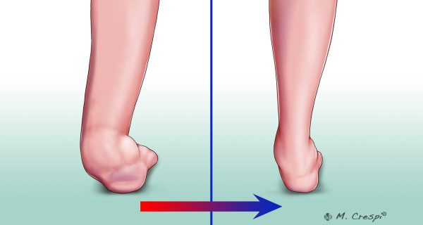 Surgical Approaches for Charcot Foot - Orthofix