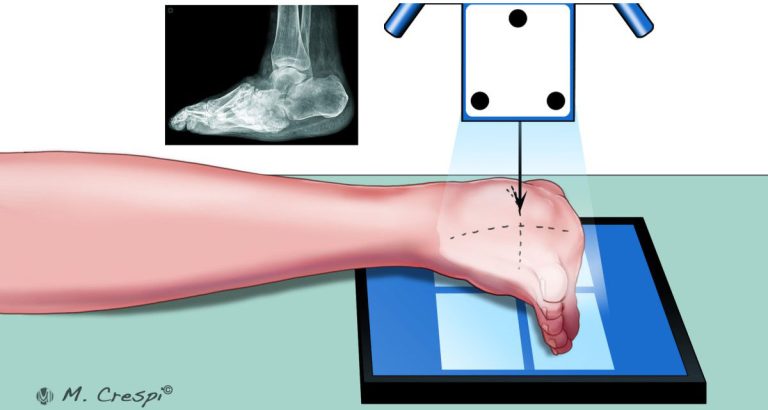 Expert Tips on How to Medically Diagnose Charcot Arthropathy - Orthofix