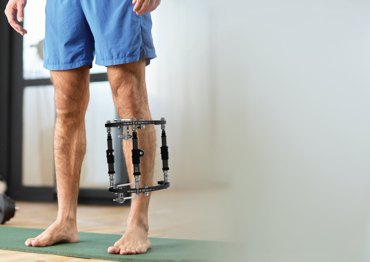 Internal Fixation vs External Fixation - Orthofix