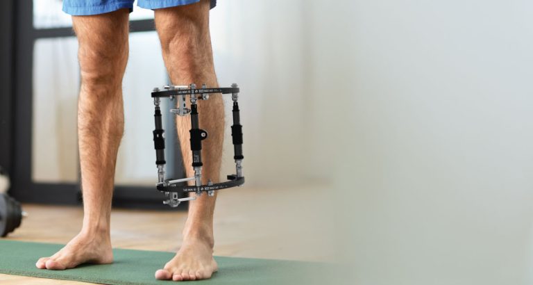 Foot and Ankle Charcot Reconstruction with External Fixation - Orthofix