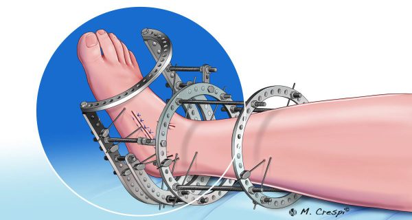 Foot and Ankle Charcot Reconstruction with External Fixation - Orthofix