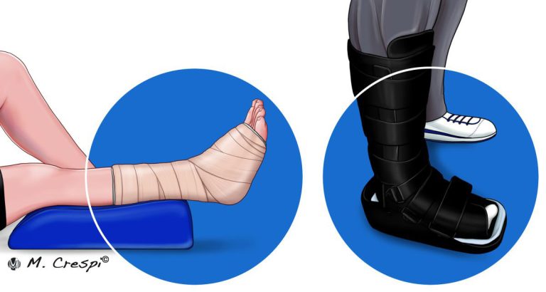 Surgical Approaches for Charcot Foot - Orthofix