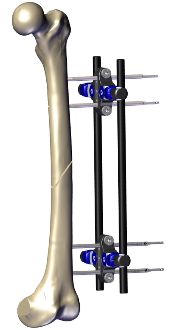 3A56 for Fractures - Orthofix