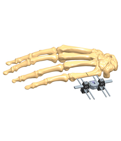 1A1 for Fractures - Orthofix