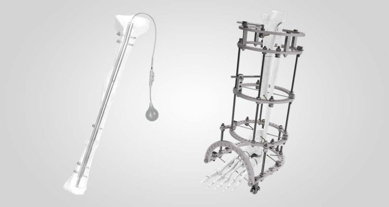 The Bone Transport Technique - Orthofix